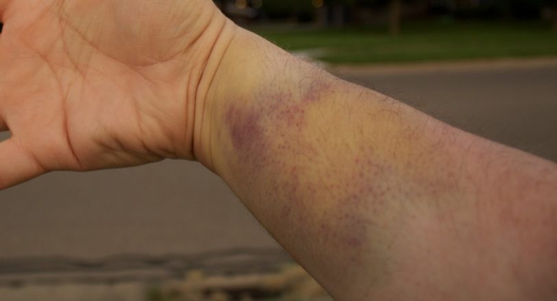 Czego objawem są siniaki? - Czytelnia apteki Cefarm24